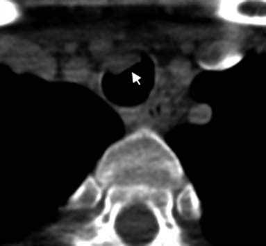 A B Axial CT Images A B From The Levels Of Larynx A And Trachea