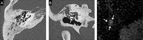Radiological Evaluation Of The Postsurgical Middle Ear Radiología