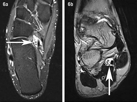 Figure 6 From Mri Of Ankle And Foot Injuries In Ballet Dancers