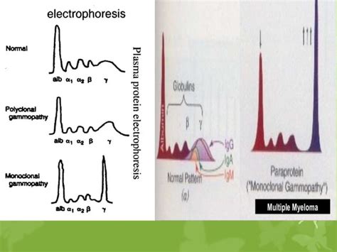 Multiple Myeloma Case Presentation Pptx Multiple Myeloma Case Presentation Pptx