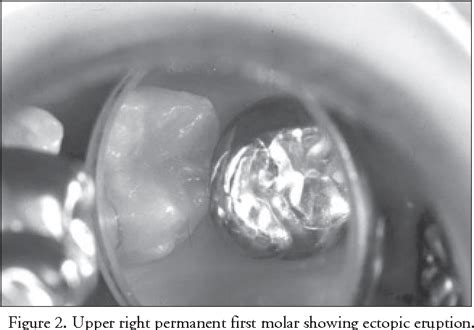 Figure 2 From Simple Treatment Of Ectopic Eruption With A Triangular