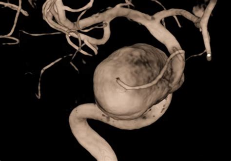 Brain Aneurysm Professor Leon Lai Neurosurgeon Melbourne