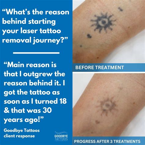 Goodbye Tattoos On Linkedin Tattooremoval