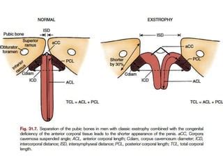Exstrophy Epispadias Complex PPT