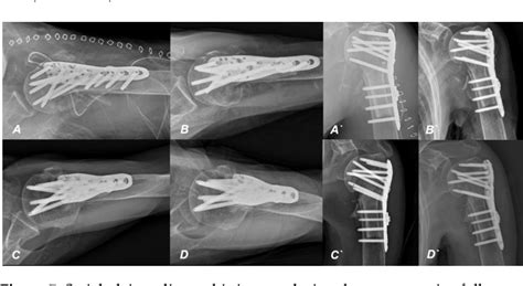 Figure 1 From Novel Use Of A Fibular Strut Allograft With Fibular Head