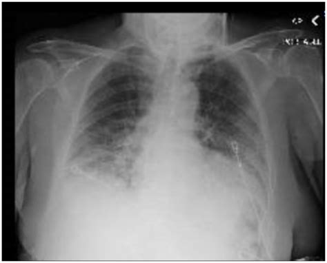 Chest Radiograph On Admission Showing Basilar Opacities Blunting Of