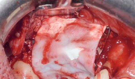 Horizontalvertical Defect In The Anterior Maxilla 2 Teeth Gap Geistlich