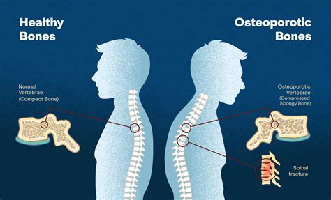 Osteoporosis And The Spine National Spine Health Foundation