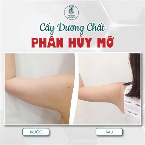 Tiêm Botox Thon Gọn Bắp Tay Giảm Mấy Cm Giữ Bao Lâu Bảng Giá 2024