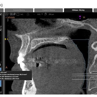 Mid Sagittal CBCT Image Showing The Airway Measurements Obtained