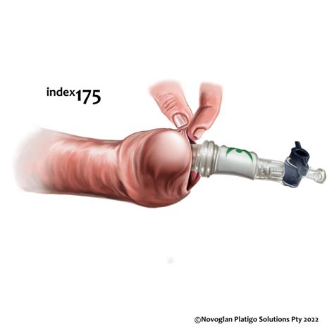 Novoglan Non Surgical Phimosis Treatment Foreskin Expander Kit Mens