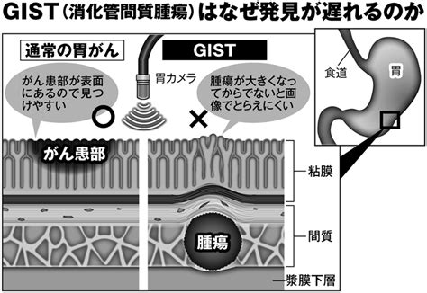 萩原健一さん死因間質性がん なぜ異変に気づけないのかNEWSポストセブン Part