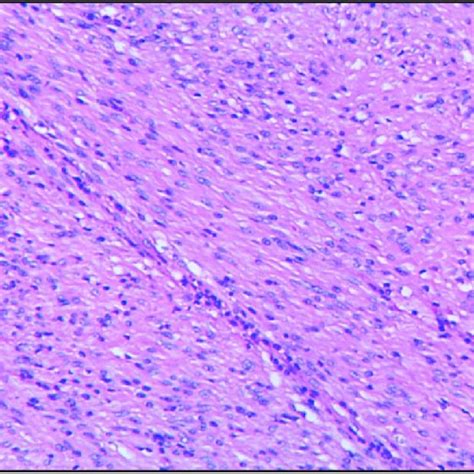 The Photomicrograph Of Lesion Included Spindle Shaped Cells Download