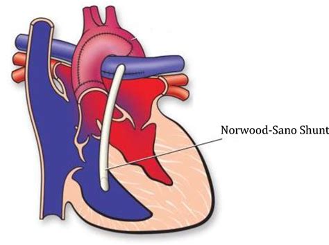 Modified Glenn Procedure