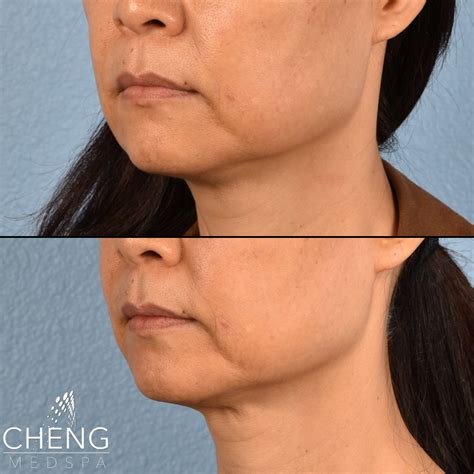 Ultherapy Before And After Artofit