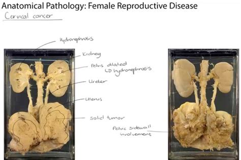 Anat Path Cervical Carcinoma Flashcards Quizlet