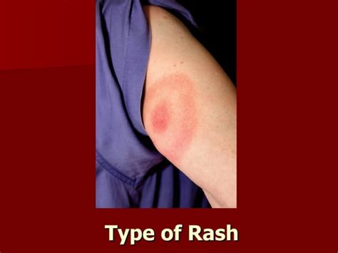 Lyme Disease Rash PPT