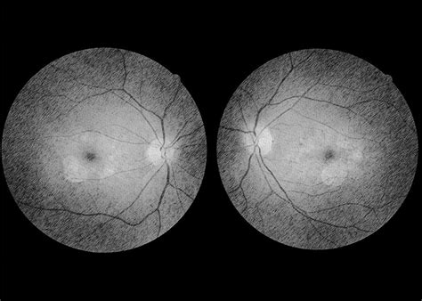 Pattern Dystrophy Pattern Dystrophy