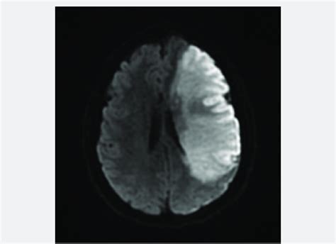 Diffusion Weighted Imaging Mri Photograph Of Patients Ischemic Stroke Download Scientific
