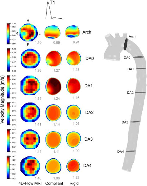 Velocity Contour Comparison Between 4dmr Compliant And Rigid Cfd