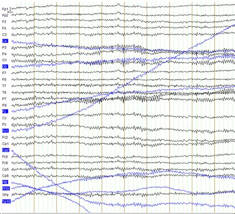 Getting To Know Eeg Artifacts And How To Handle Them In Brainvision Analyzer
