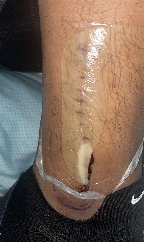 Week 3 After Ankle Orif Surgery And I M Bleeding R Brokenbones