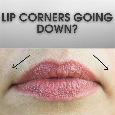 Downturned Lip Corners Upturned Lips Corners Face Rejuvenation
