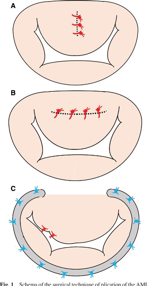 Figure From Surgical Management For Systolic Anterior Motion SAM Of The Mitral Valve In