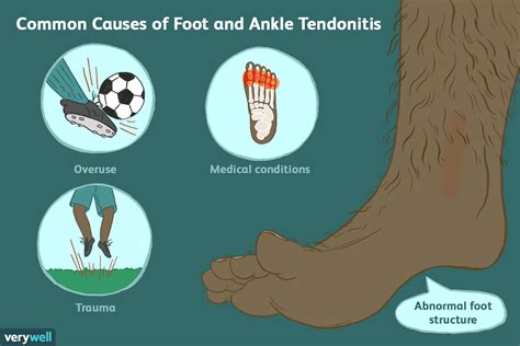 Running Shoes For Extensor Tendonitis Style Guru Fashion Glitz Glamour Style Unplugged
