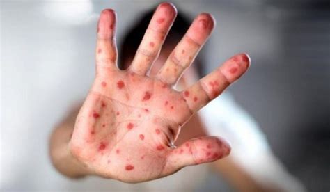 Улаанбурхан өвчний зөөвөрлөгдөн батлагдсан гурав дахь тохиолдол бүртгэгдлээ