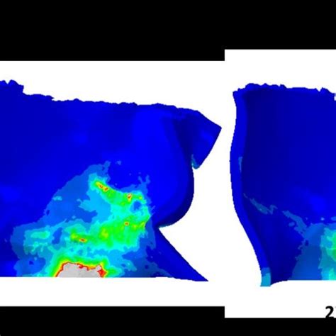 Contour Plots Von Mises Stress In The Aortic Sinus Mpa Post