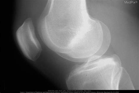 Intercondylar Notch Femur