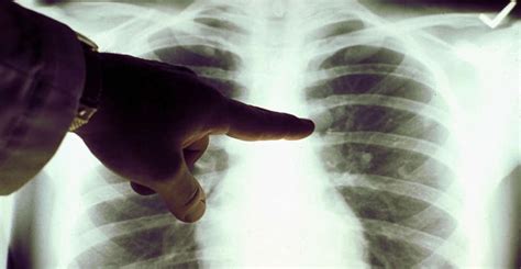 Everything You Need To Know About Lung Cancer