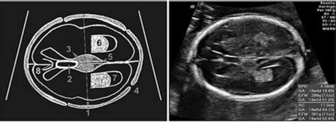 Normal 2nd And 3rd Trimester Anatomy Flashcards Quizlet