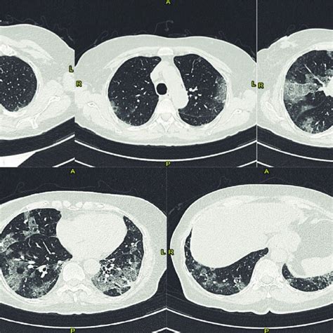 Ct At The 1st Hospitalization March 2020 Bilateral Ground Glass