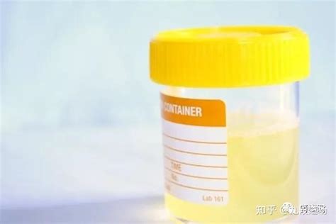 除了切扁桃体、吃降压药，临床还有哪些治疗iga肾病的方法？ 知乎