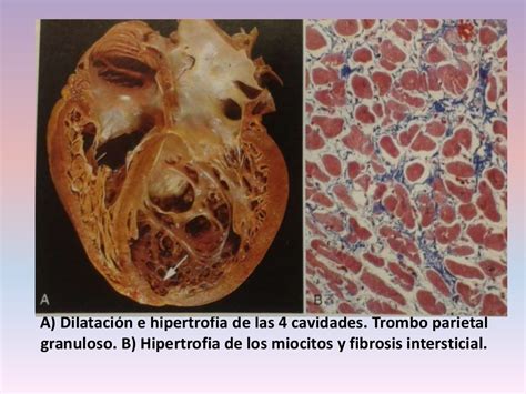 Patologia De Miocardiopatia Dilatada