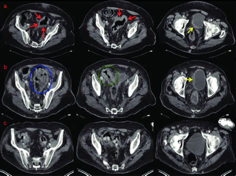Row A Ct Scan Four Months Prior To Recto Sigmoid Dlbcl Diagnosis Download Scientific Diagram