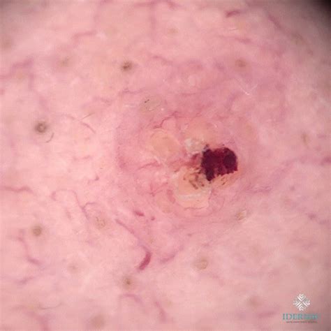 Базальноклітинний Рак Шкіри Досвід Діагностики в Центрі Idermic