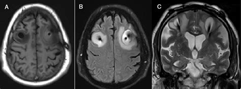Caso 1 Edema Cerebral Visualizado Mediante Rm A Secuencia T1 Plano