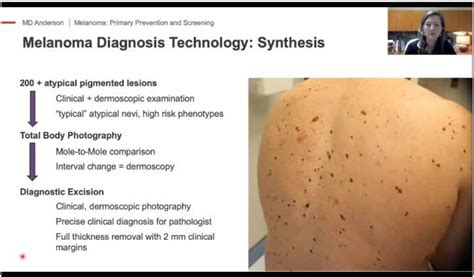 Melanoma Dermoscopy