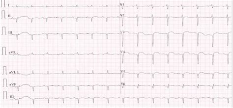 Ecg Performed Ten Days Later Showed Spontaneous Regression Of The Av