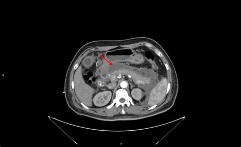 Peripancreatic Necrosis Alone With Fat Necrosis In The Anterior Renal