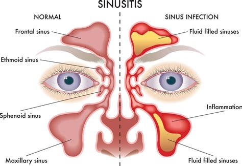 Sinusitis