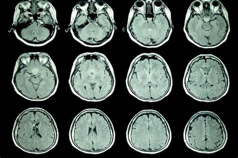 Resonancia Magnética Del Cerebro Del Paciente Foto Premium