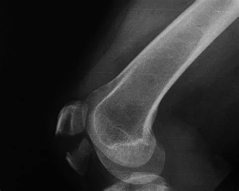 Patellar Kneecap Fracture Walking Recovery Time Physiotips