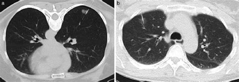 Computed Tomography Guided Hook Wire Localization By Two Protocols A Download Scientific