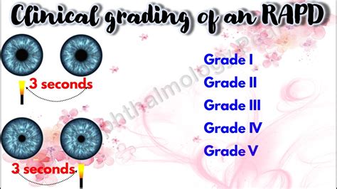 Pupil 4 Clinical Grading Of An Rapd Marcus Gunn Pupil Youtube
