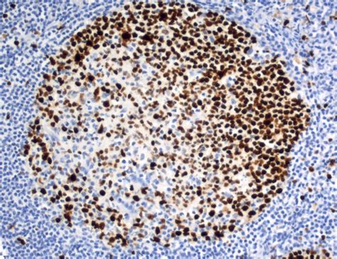 Pathology Outlines Reactive B Cell Rich Lymphoid Proliferations That