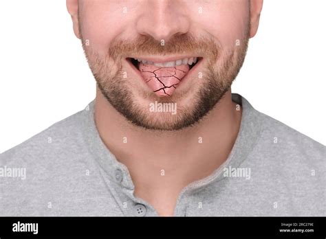 Dry Mouth Symptom Man Showing Dehydrated Tongue On White Background